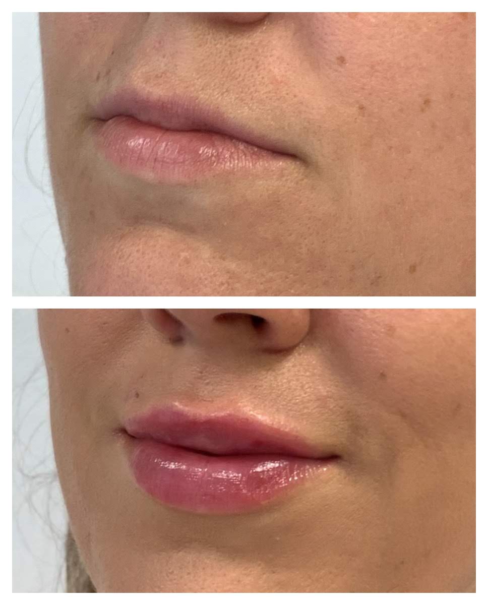 Povečanje ustnic | Estetika SMedicina